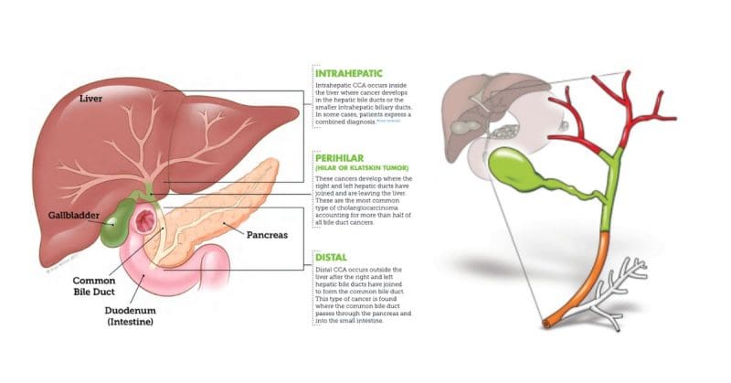 Newly Diagnosed Patients - Cholangiocarcinoma Australia